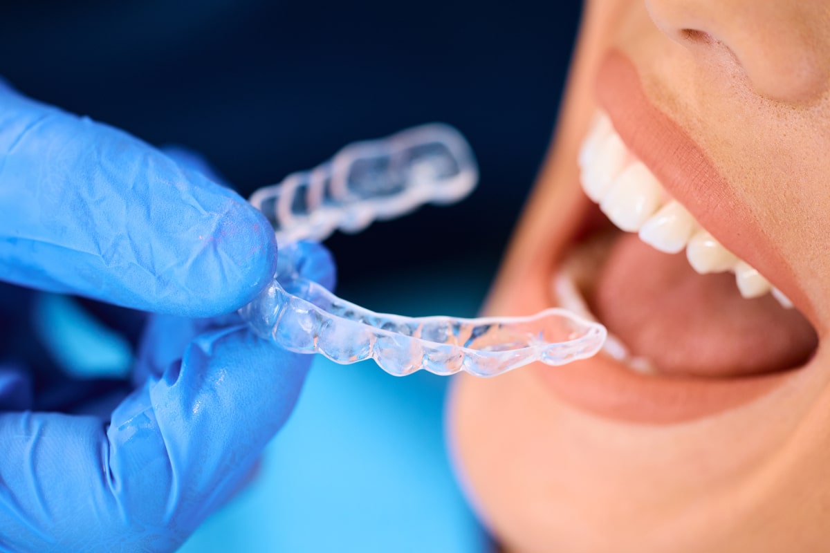 Clear Aligners In Ottawa - Watersedge Dental Laboratory Inc.