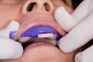Complete Dentist Guide to Bite Blocks and Bite Registrations